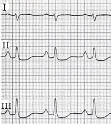 Veräderungen der P- Welle 2