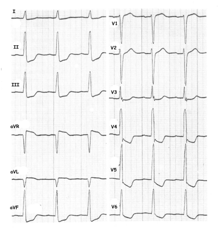 Veränderungen des QRS- Komplexes 1